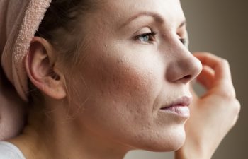 Understanding Your Rosacea Triggers: The Key to Managing Flare-Ups and ...
